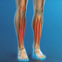 Pijn in schenen? Alles wat je moet weten over shin splints